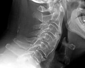A Closer Look at DISH: Idiopathic Skeletal Hyperostosis Explained
