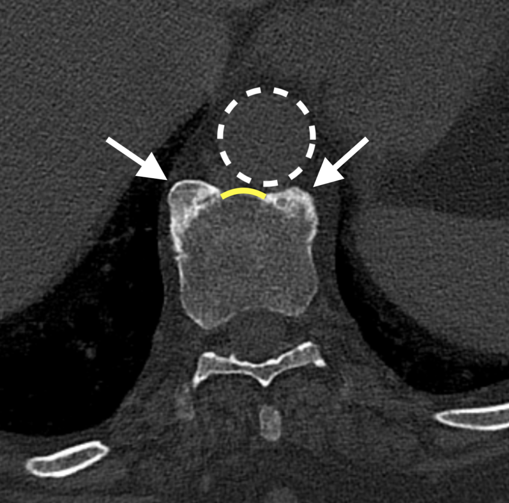 A Closer Look at DISH: Idiopathic Skeletal Hyperostosis Explained